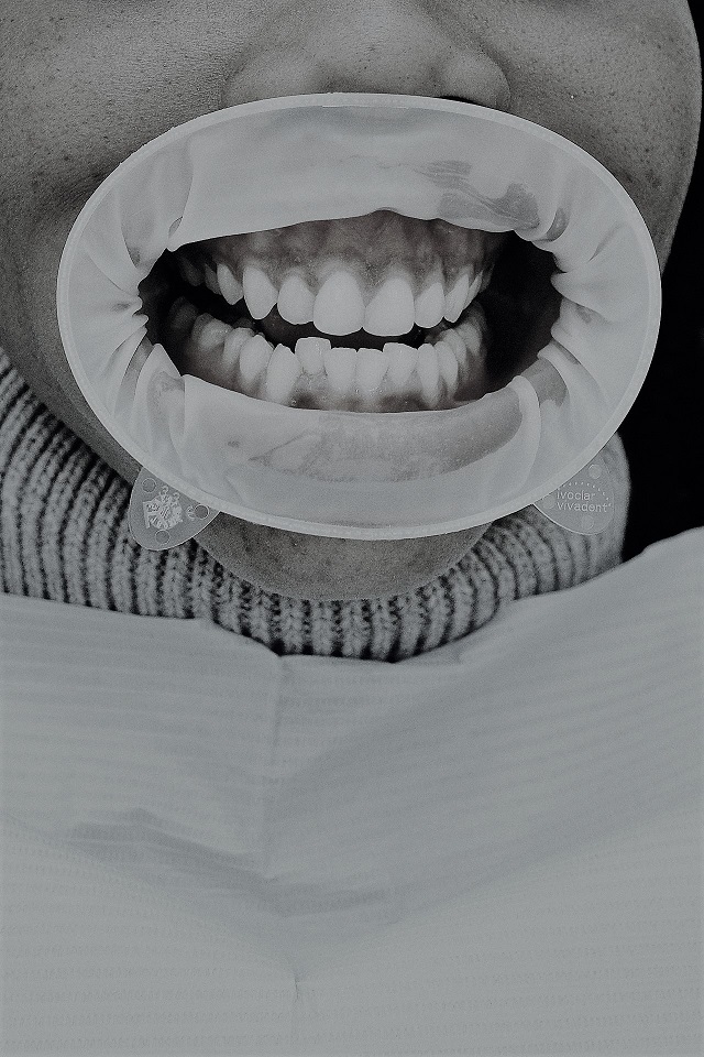 Qué es un abrebocas odontológico - OdontoCenter